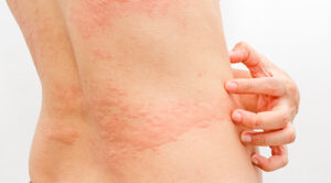 Kenali 7 Jenis Penyakit Kulit dan Cara Mengatasinya