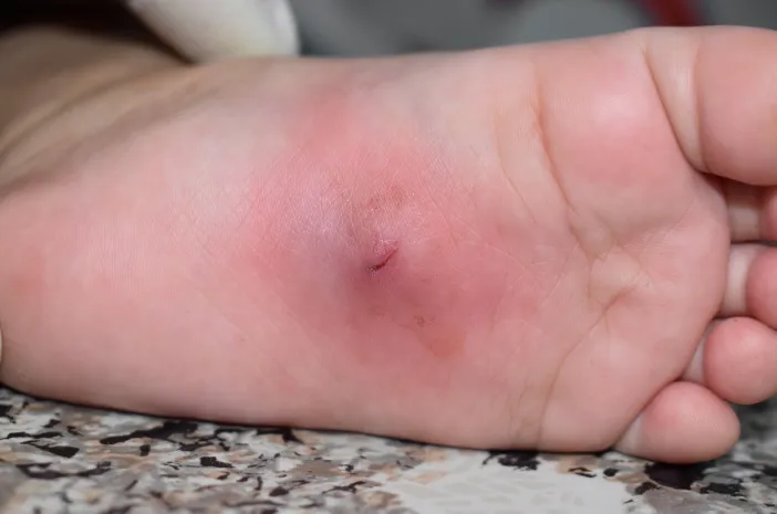 Selulitis - Gejala, Penyebab, dan Pengobatan | Halodoc