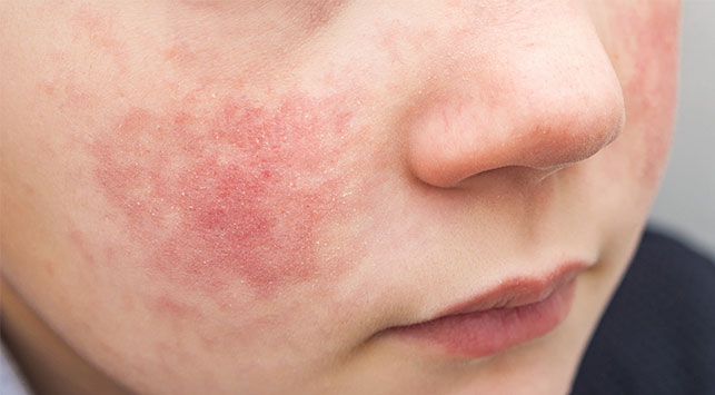 Sindrom Cushing- Gejala, Penyebab, dan Pengobatan | Halodoc