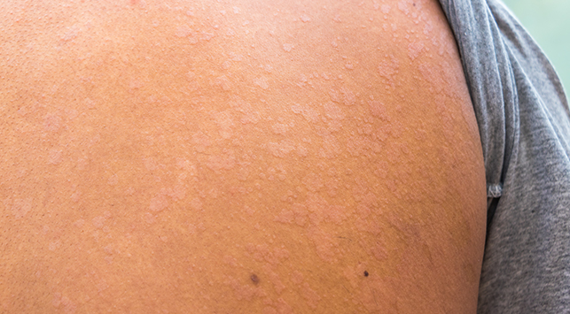 Apa Itu Panu? Gejala, Penyebab, Pengobatan, dan Pencegahan