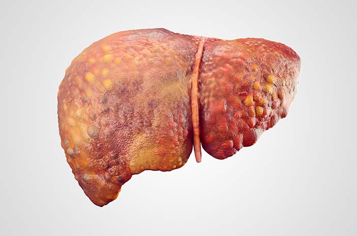 Apa Itu Sirosis Hati? Gejala, Penyebab, dan Pengobatan | Halodoc