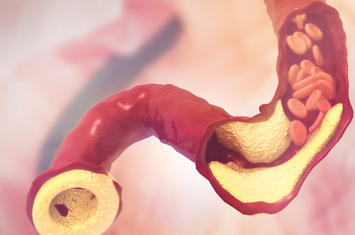 Apa itu Trigliserida? Gejala, Penyebab & Pengobatan - Halodoc