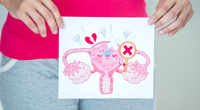 Polip Rahim - Gejala, Penyebab, dan Pengobatan | Halodoc