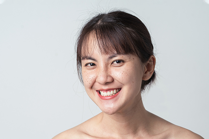 5 Fakta tentang Freckle yang Menarik untuk Diketahui