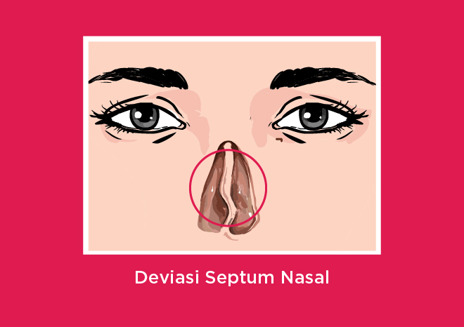 Ketahui Gejala Deviasi Septum yang Sering Tidak Disadari