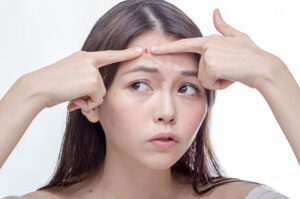 Ketahui Penyebab dan Cara Menghilangkan Jerawat di Jidat