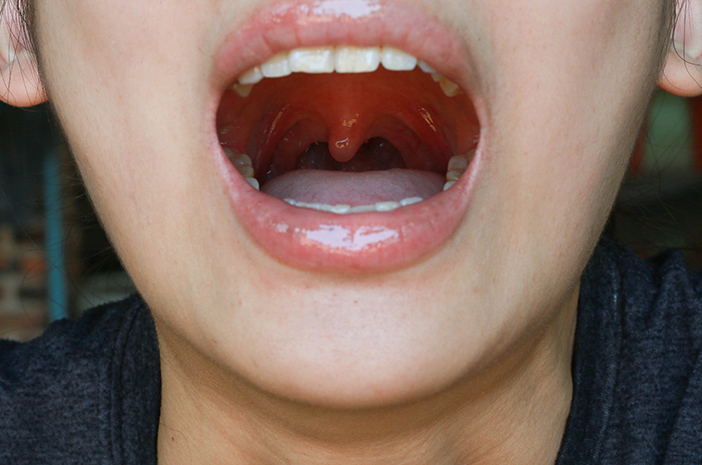 Uvula Bengkak Ini Langkah Penanganan Yang Bisa Dilakukan