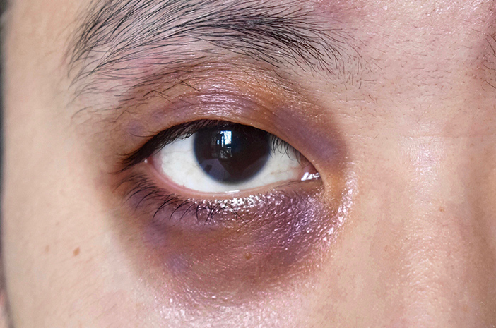 Cara Mengatasi Racoon Eye atau Lebam di Sekitar Mata