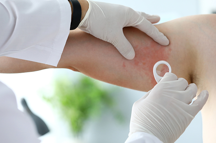 Muncul sebagai Reaksi Alergi, Ini Fakta tentang Histamin