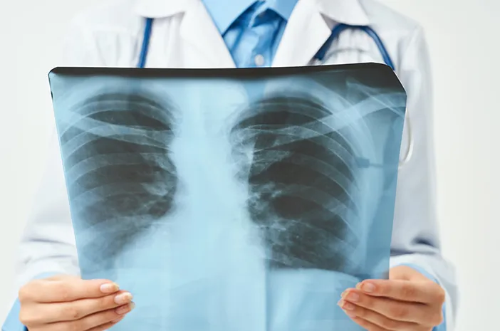 Ini 6 Obat Alami Paru-Paru yang Dapat Melegakan Pernapasan