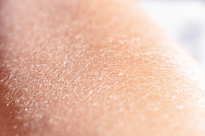 Ini Pengobatan dan Pencegahan untuk Kondisi Xerosis