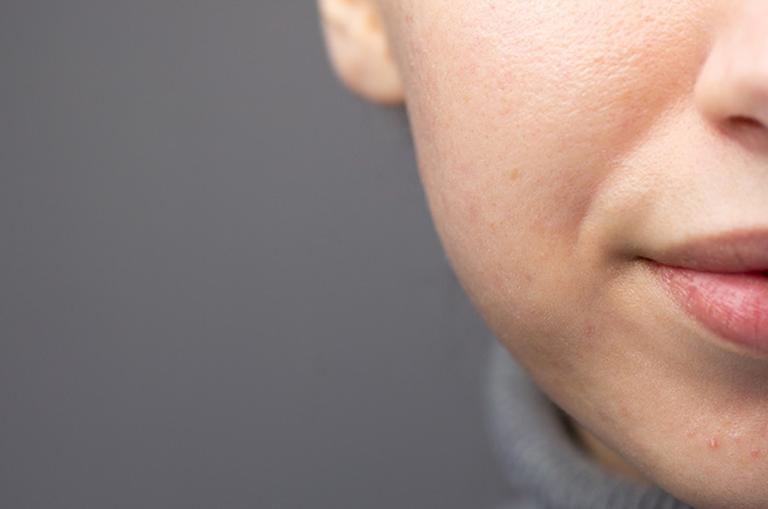 Penting, Ini Cara Mengenal Skin Barrier yang Rusak