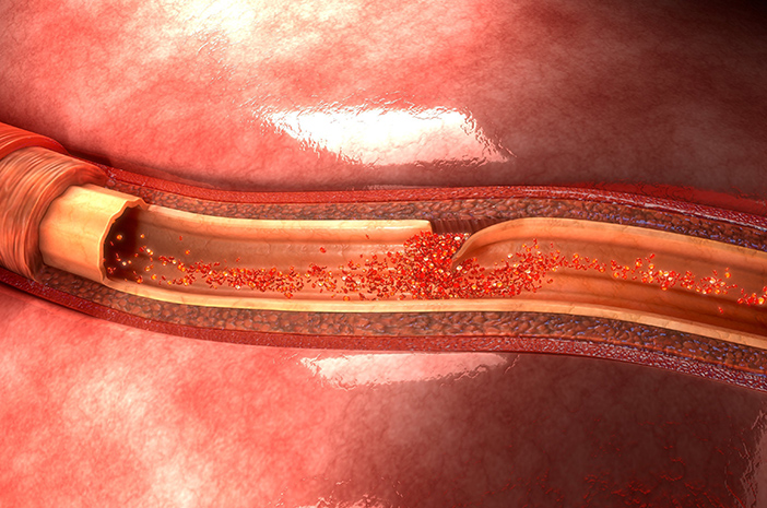 Waspada, Ini 8 Gejala Diseksi Aorta yang Perlu Diketahui