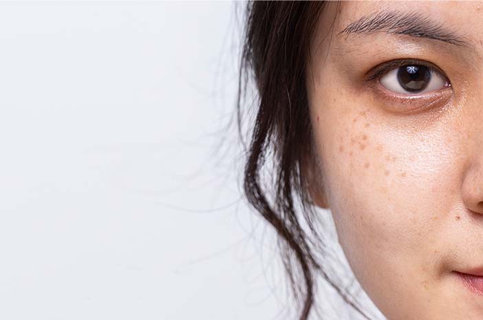 7 Jenis dan Penyebab Lentigo pada Kulit yang Perlu Diketahui