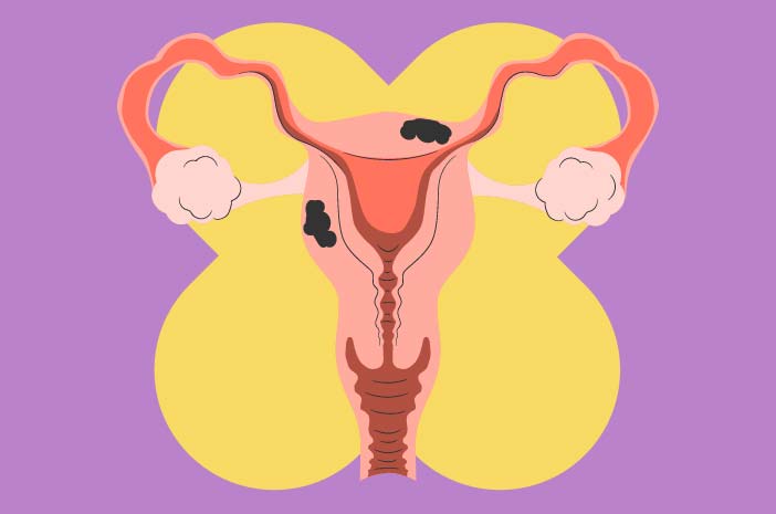 Mengenal Bahaya Kista Endometriosis bagi Kesehatan Tubuh
