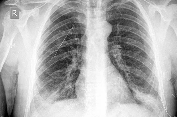 Kenali 5 Gejala Popcorn Lung yang Menyerang Paru-Paru