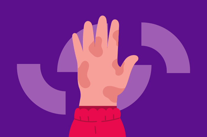 Bukan Diasingkan, Ini 3 Langkah Mengobati Kusta