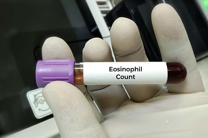 Mengenal Fungsi Tes Kadar Eosinofil bagi Kesehatan Tubuh