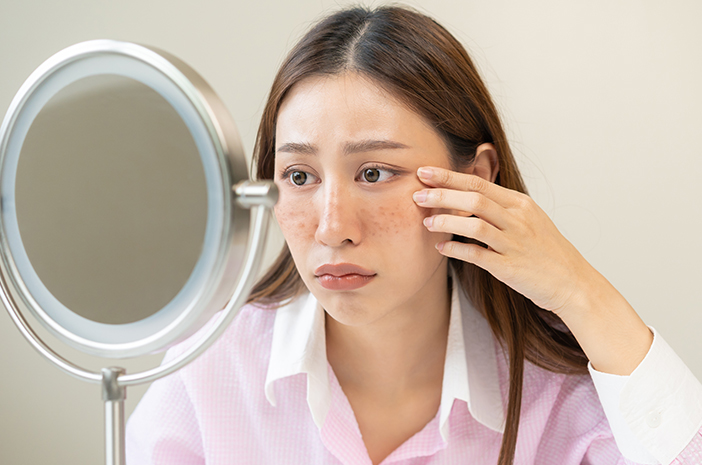 Xeroderma Pigmentosum - Gejala, Penyebab & Pengobatan | Halodoc