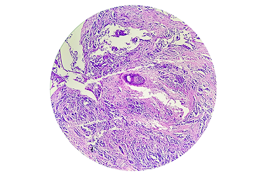 Ini Berbagai Penyebab Calcinosis Cutis yang Penting Diketahui