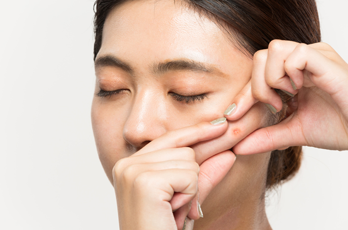 6 Cara Menghilangkan Bekas Bisul dengan Mudah