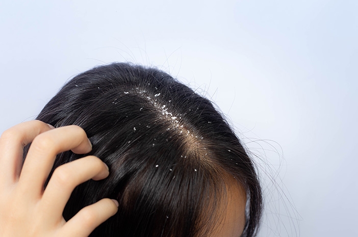 Ini Penyebab Dermatitis Seboroik dan Cara Mengobatinya