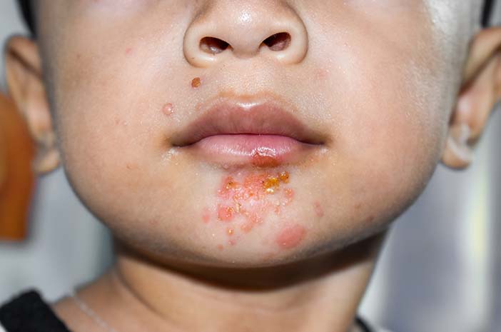 Mengenal Staphylococcus Aureus dan Penyakit yang Ditimbulkannya