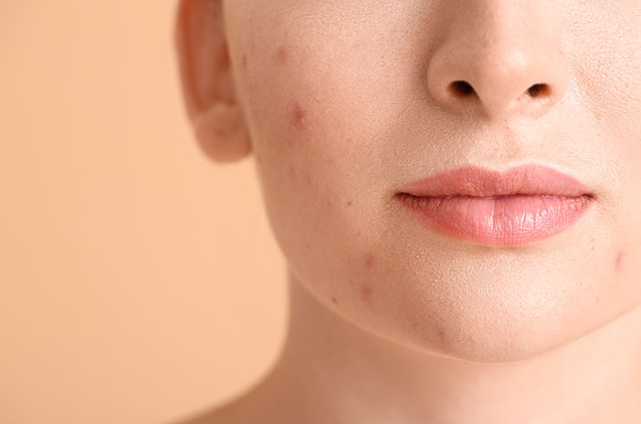 Apa itu Jerawat? Gejala, Penyebab & Pengobatan - Halodoc