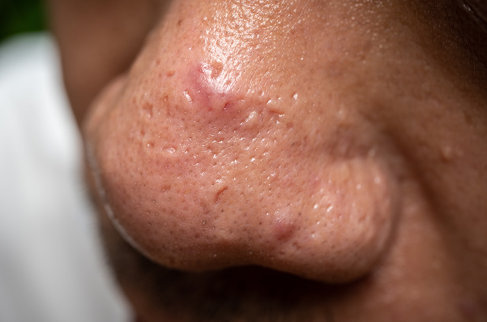 7 Cara Menghilangkan Jerawat Batu di Hidung Secara Alami dan Medis
