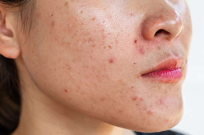 Jerawat di Bibir? Ini Penyebab dan Cara Mengatasinya