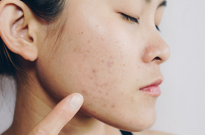 Perlu Diketahui, Inilah 5 Jenis Jerawat dan Cara Mengatasinya