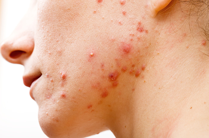 Ini 9 Cara Menghilangkan Jerawat Secara Alami dalam 1 Hari