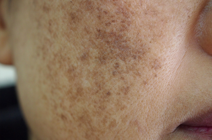 Jarang Disadari, Ini 4 Daun Penghilang Flek Hitam di Wajah