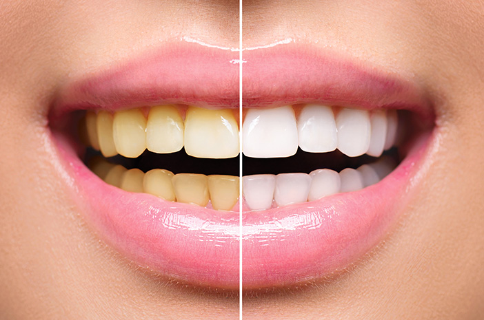 Bleaching Gigi - Tujuan, Jenis, dan Prosedur | Halodoc