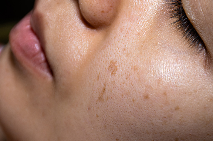 Ada Bopeng Bekas Jerawat, Ini Cara Menghilangkannya