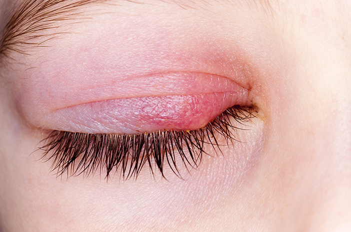 Ini Penyebab Bintitan yang Wajib Diketahui