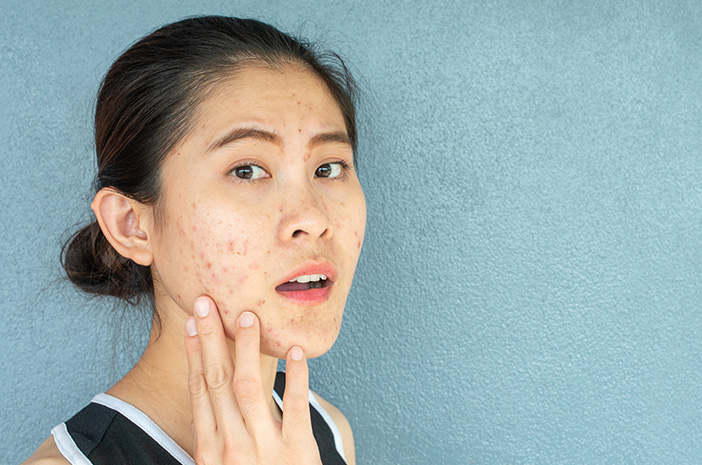 Ini 3 Cara Mengempeskan Jerawat dalam Semalam