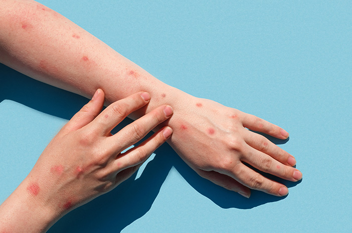 Ini Mitos dan Fakta seputar Monkeypox yang Perlu Diketahui