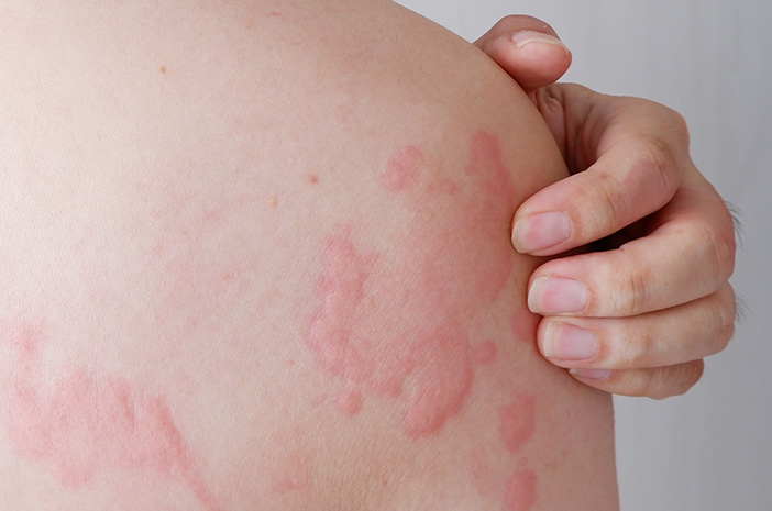 Bentol Merah Gatal: Kenali Penyebab dan Cara Mengatasinya