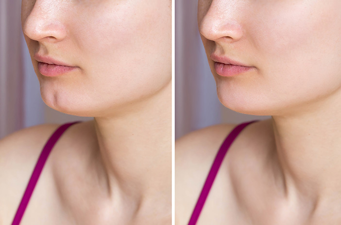 Mengapa Seseorang Bisa Memiliki Dagu Belah? Ini Penjelasannya