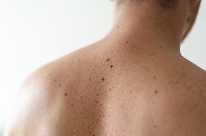 Ini Penyebab Skin Tag yang Perlu Diketahui