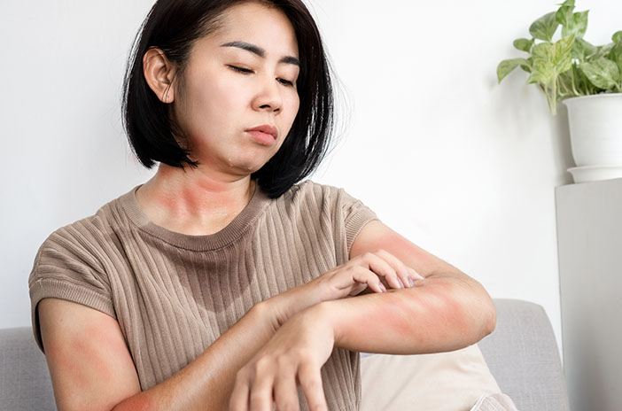 Ini 5 Hal yang Perlu Dilakukan saat Kaligata atau Biduran Kambuh