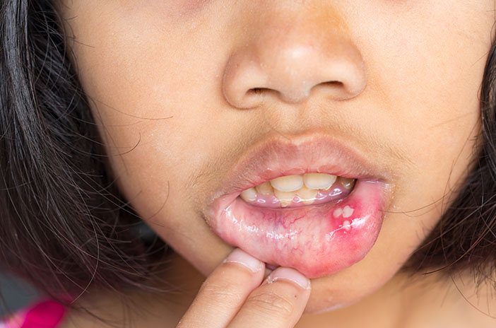 Kenali Penyebab Sariawan pada Anak dan Cara Pengobatannya