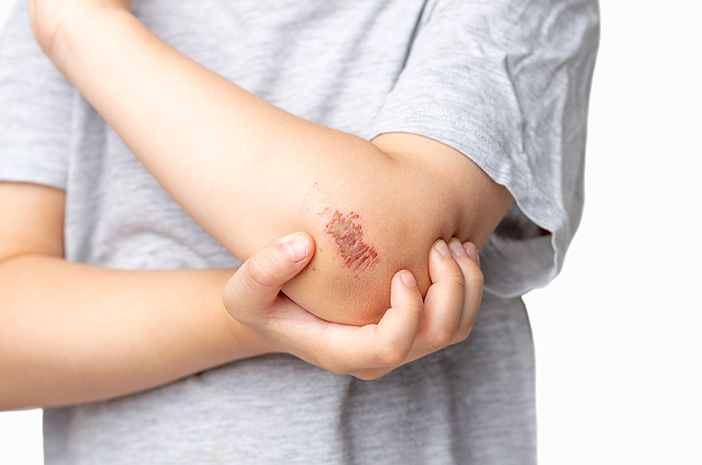 Ini 5 Penanganan Pada Luka Jatuh di Aspal agar Cepat Sembuh