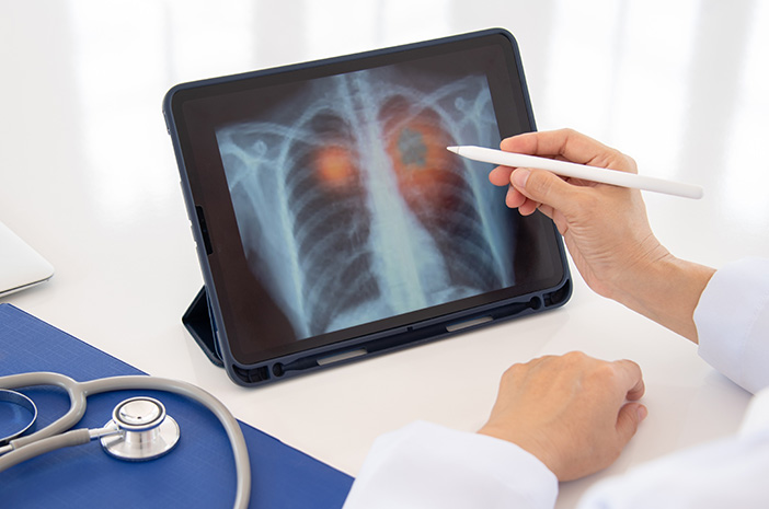 Emfisema: Ini Penyebab, Gejala, dan Semua Hal yang Perlu Kamu Tahu