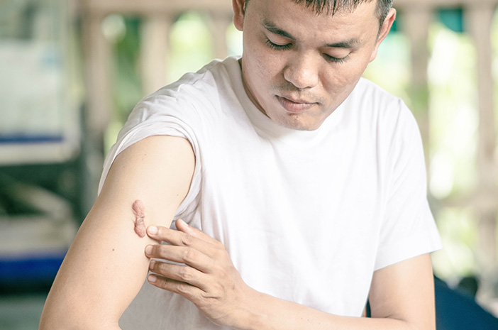 Ini Penyebab Keloid yang Perlu Diketahui