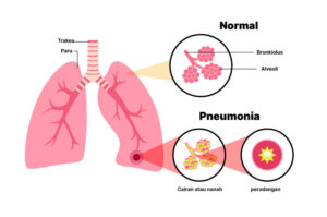 Pneumonia - Gejala, Penyebab, Pencegahan & Pengobatan