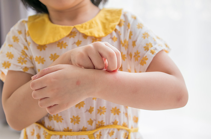 Ibu, Ini Perbedaan Bintik Merah DBD dan Biang Keringat