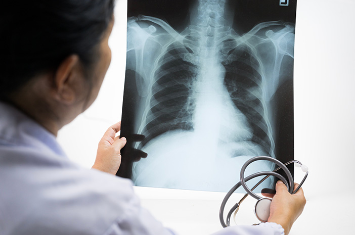 Jangan Abaikan, Ini 7 Ciri Penyakit TBC Yang Sudah Parah