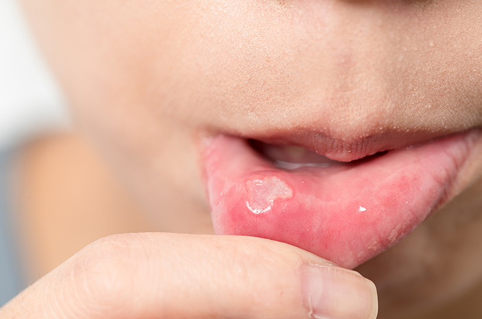 Muncul Sariawan di Bibir? Ini Penyebab, Pengobatan dan Pencegahan